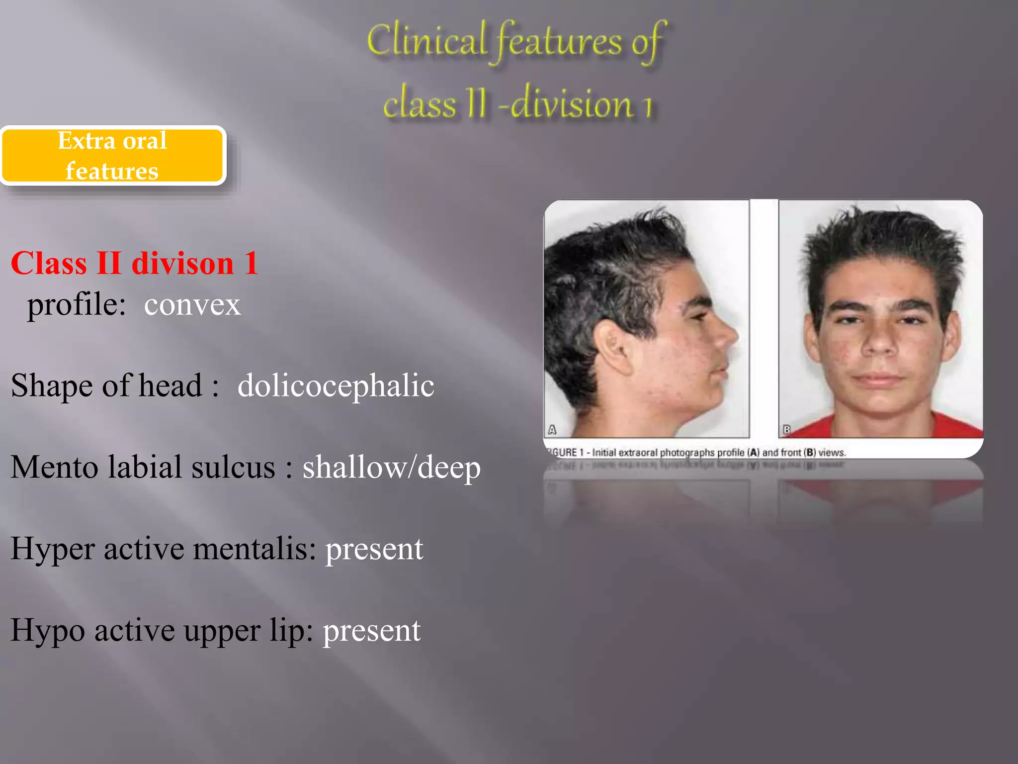 Class ii malocclusion zz | PPTX