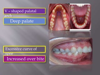 Class ii malocclusion zz | PPTX