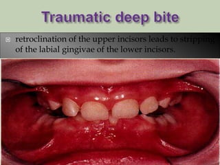 Class ii malocclusion zz | PPTX