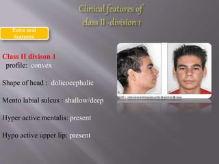 Class Ii Malocclusion Zz Pptx