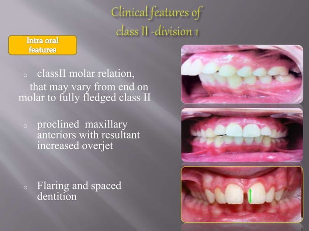 Class Ii Malocclusion Zz Ppt