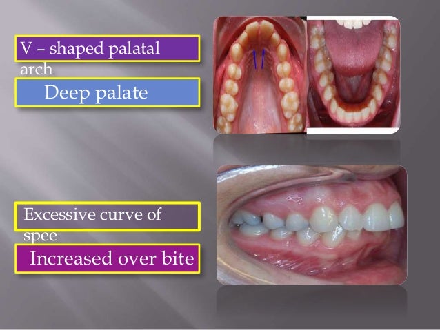 Class ii malocclusion zz