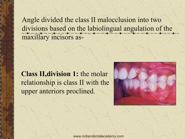Angles Class 2 malocclusion | PPT | Pregnancy | Reproductive Health