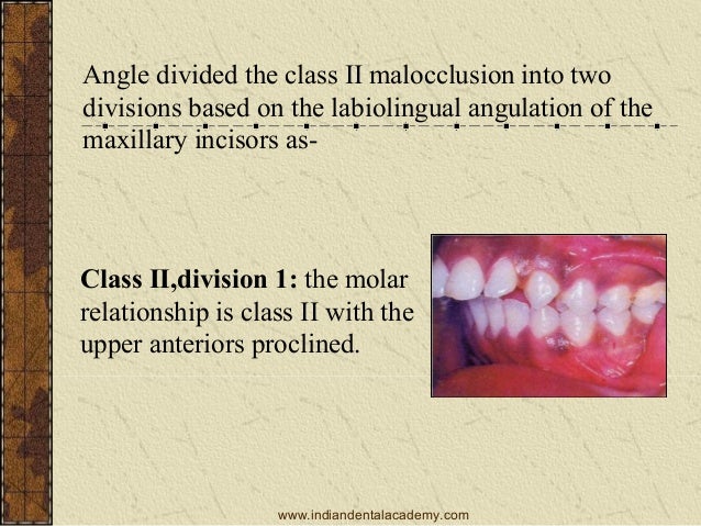 Angles Class 2 malocclusion
