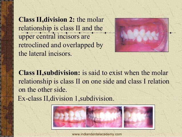 Angles Class 2 Malocclusion