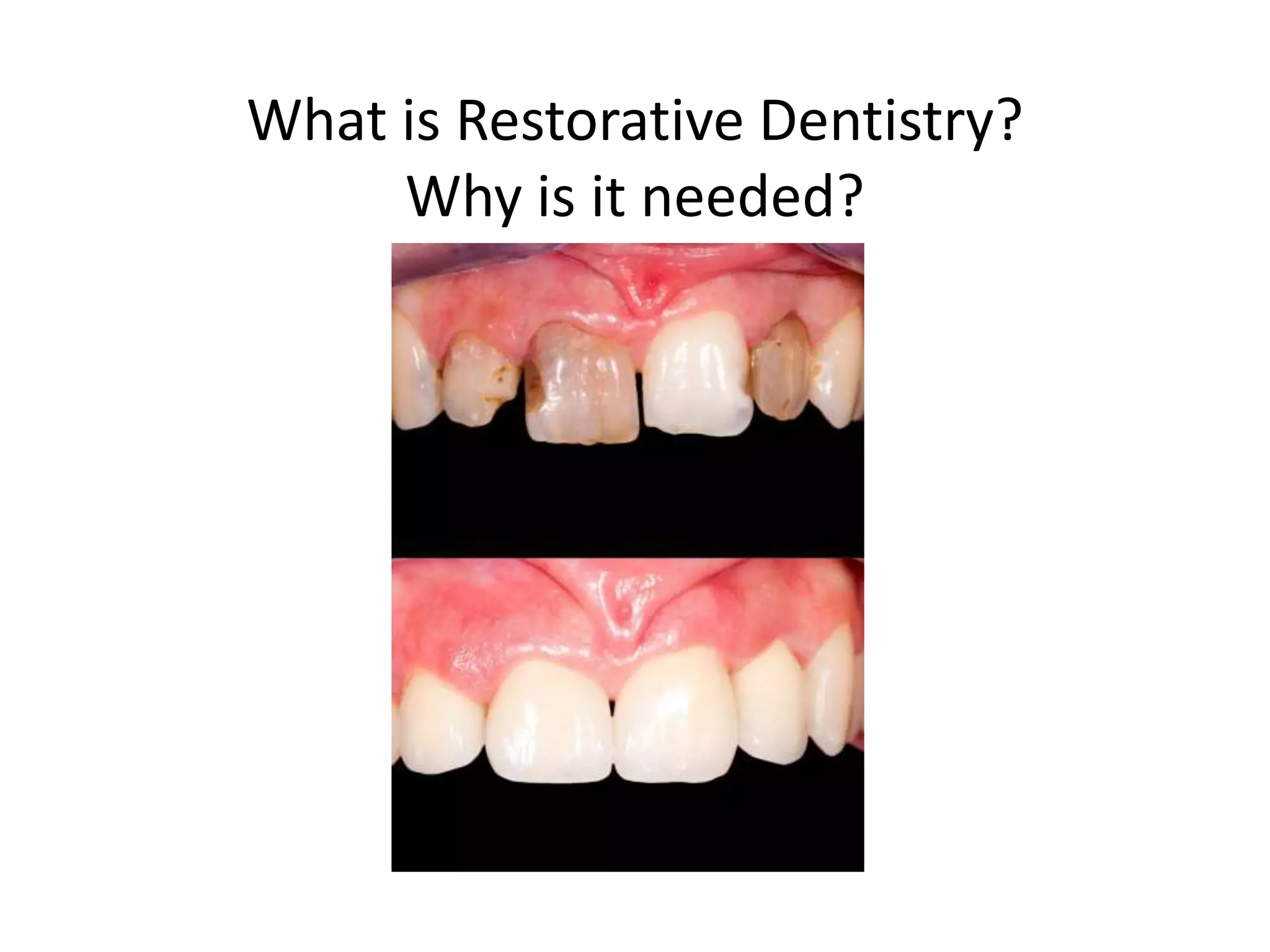 Class ii restoration | PPTX