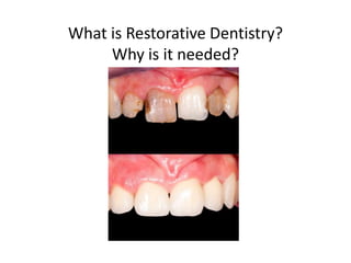 Class ii restoration | PPTX