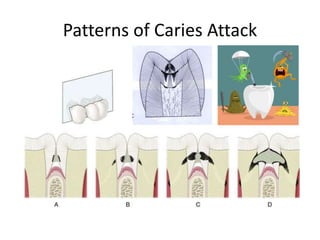 Class ii restoration | PPTX