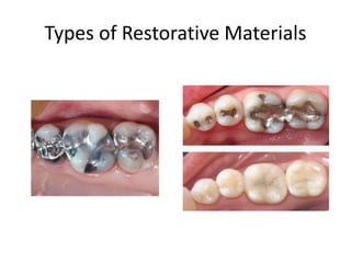 Class ii restoration | PPTX