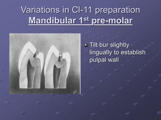 tooth prep for SAF | PPT