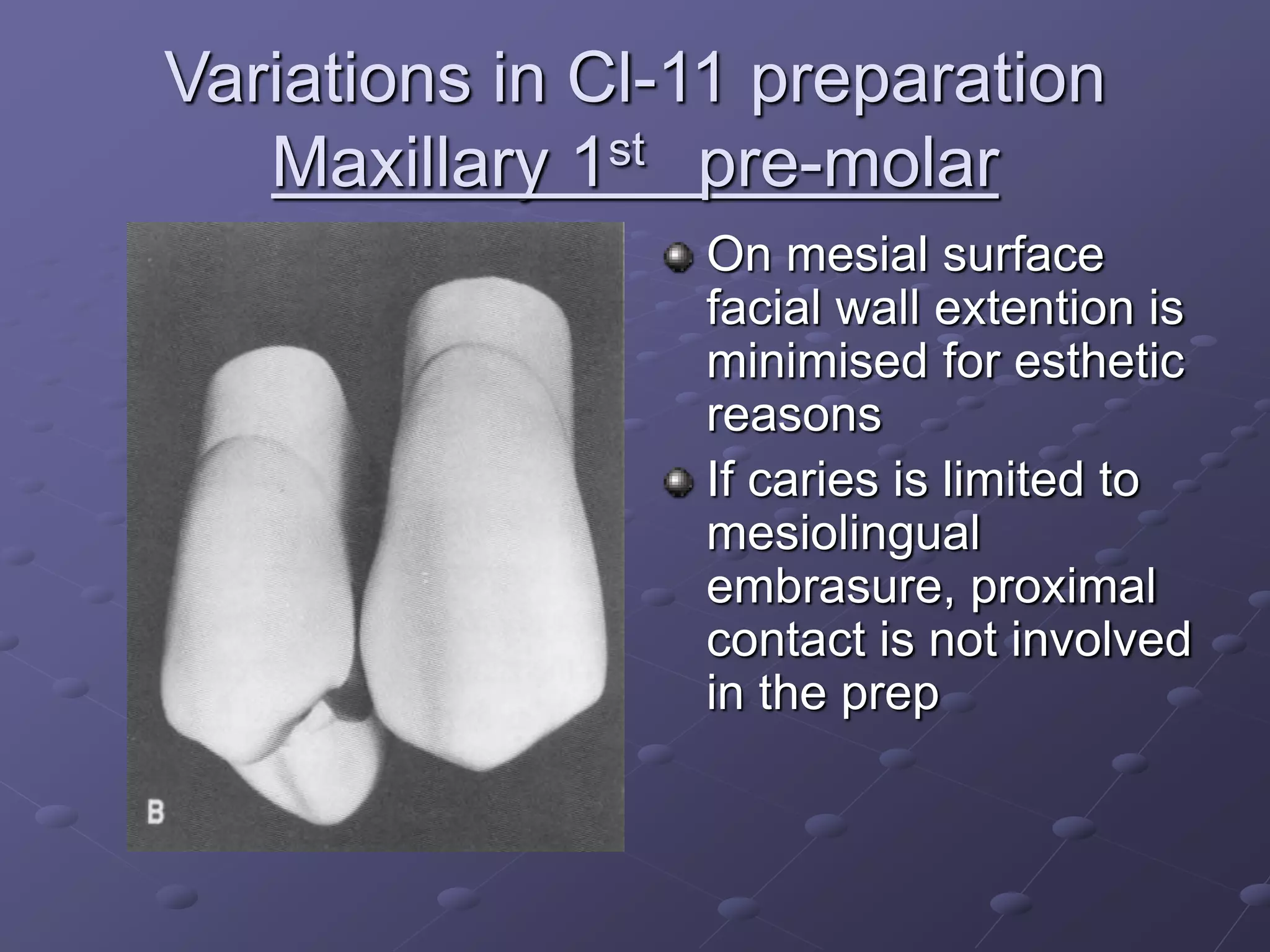 CLASS II tooth prep for SAF.ppt