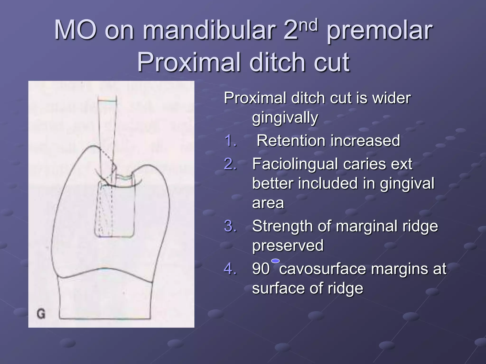 CLASS II tooth prep for SAF.ppt