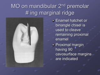CLASS II tooth prep for SAF.ppt
