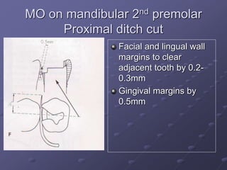 CLASS II tooth prep for SAF.ppt