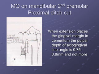 CLASS II tooth prep for SAF.ppt