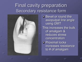 CLASS II tooth prep for SAF.ppt