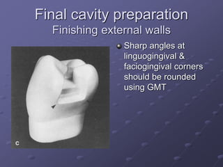 CLASS II tooth prep for SAF.ppt