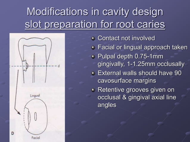 CLASS II tooth prep for SAF.ppt