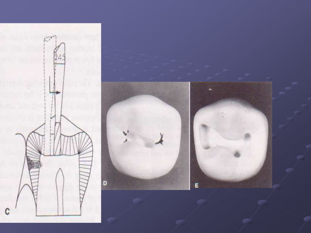 CLASS II tooth prep for SAF.ppt