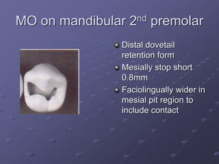 CLASS II tooth prep for SAF.ppt