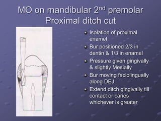 CLASS II tooth prep for SAF.ppt