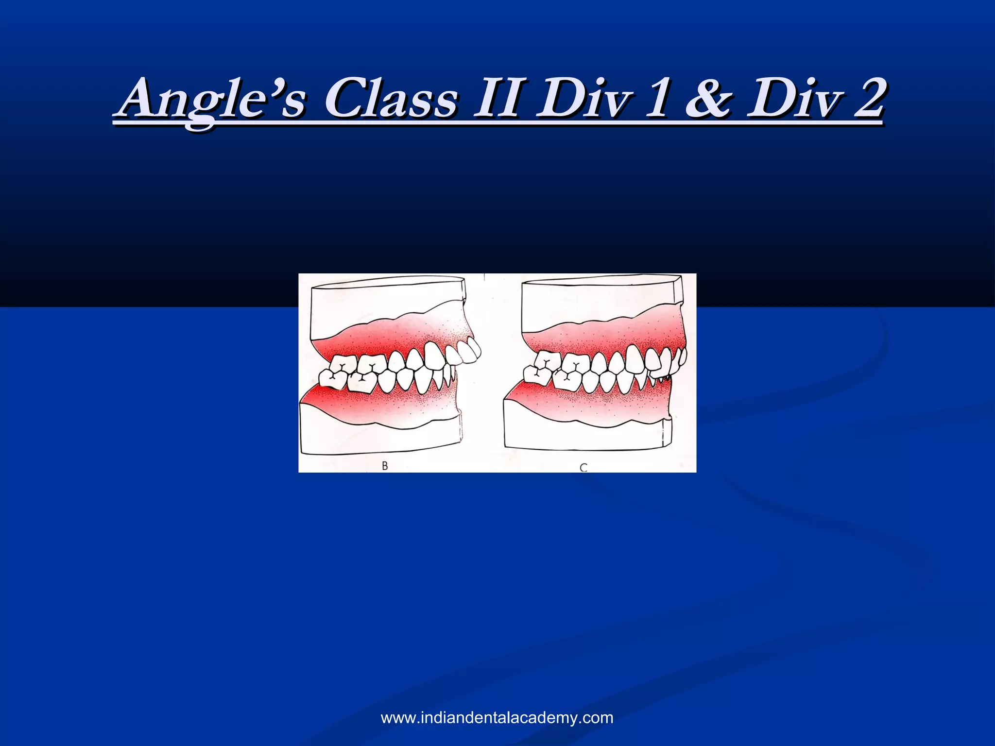 Treatment of Class 2 malocclusion | PPT