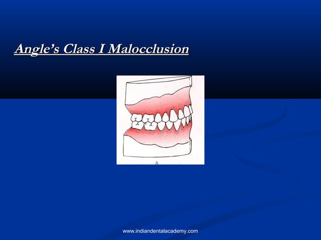 Treatment of Class 2 malocclusion | PPT | Dental Health | Diseases and ...