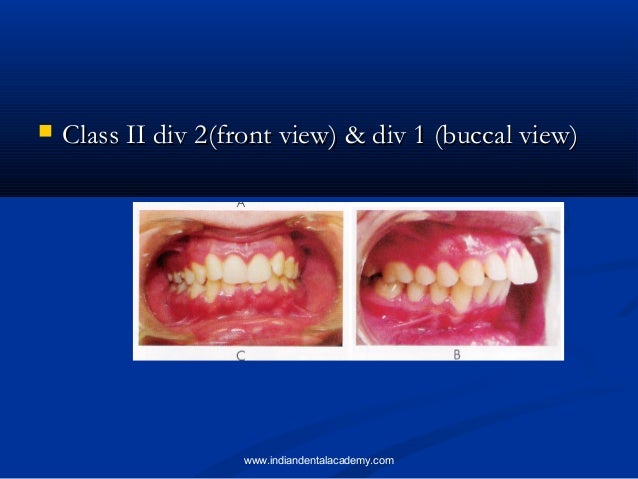 Treatment of Class 2 malocclusion