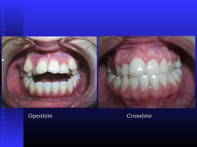 Class I Malocclusions | PPT | Dental Health | Diseases and Conditions