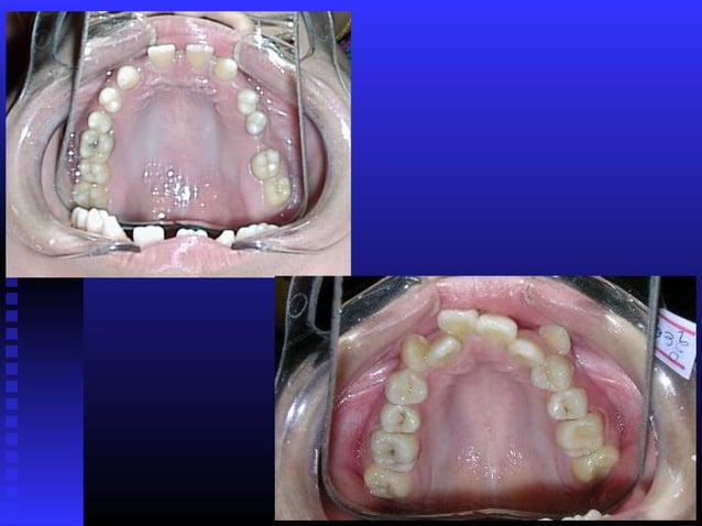 Class I Malocclusions | PPT | Dental Health | Diseases and Conditions