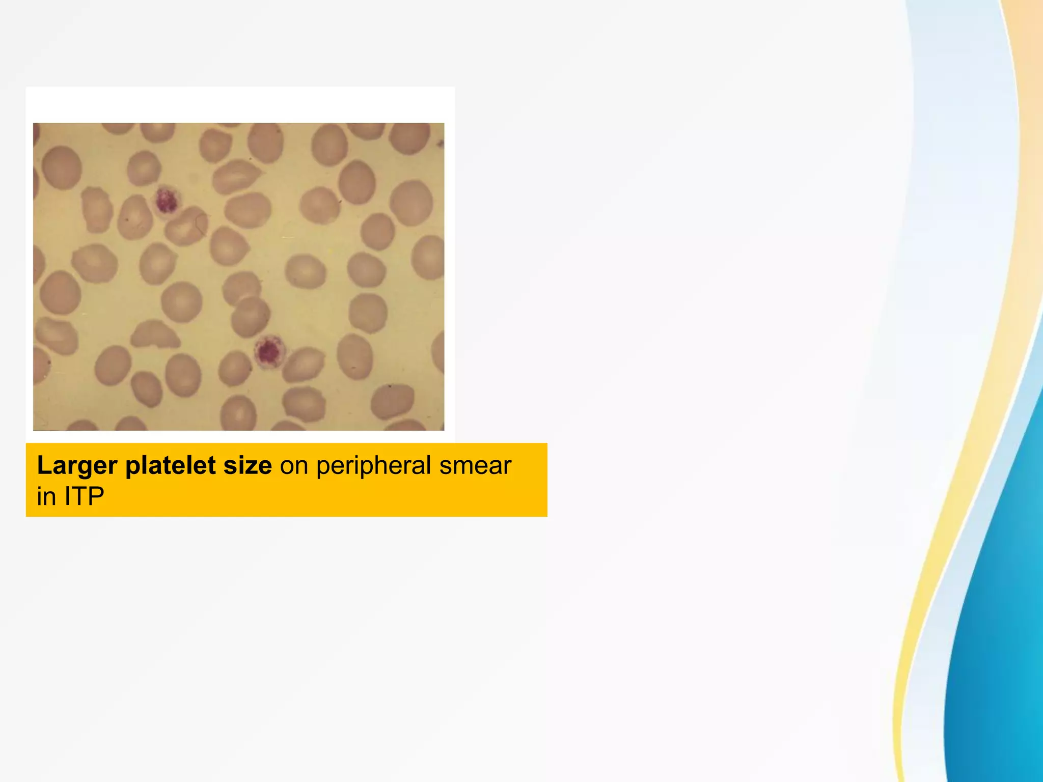 Immune Thrombocytopenic Purpura | PDF