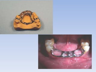 kennedy class IV | PPTX