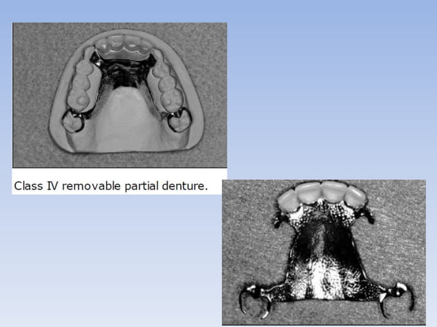 kennedy class IV | PPTX