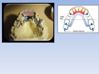 kennedy class IV | PPT