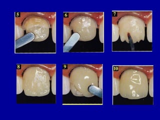 Class IV Restorations .ppt