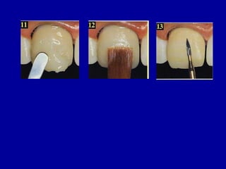 Class IV Restorations .ppt