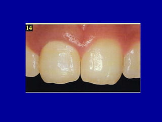 Class IV Restorations .ppt