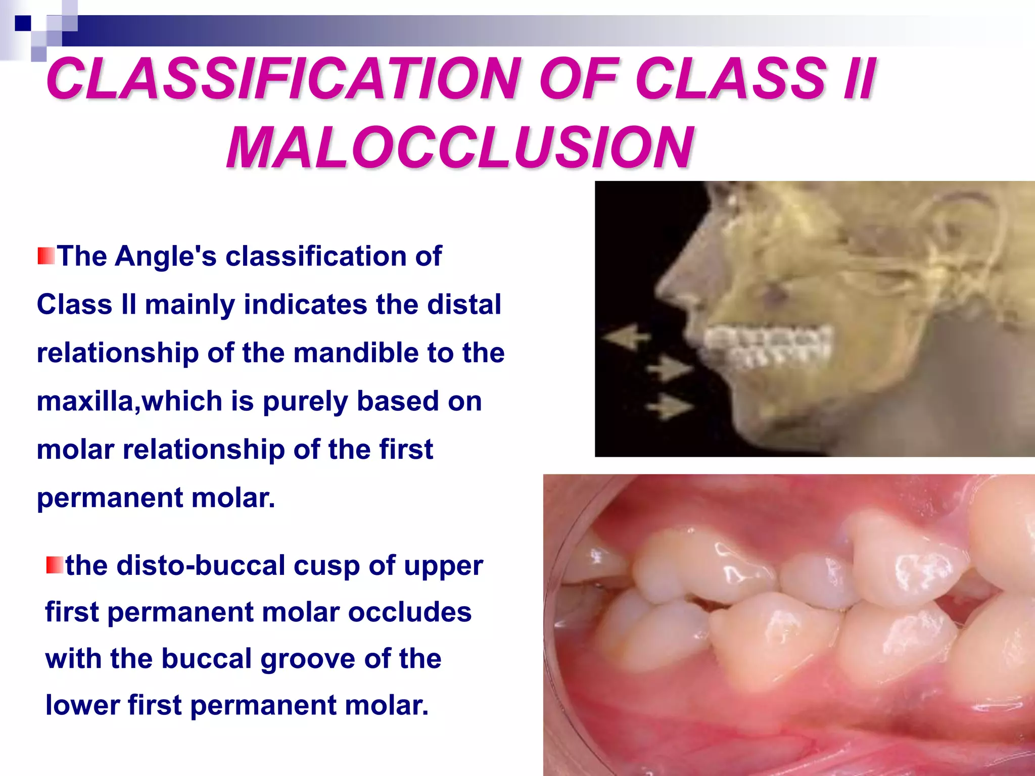 Classll etiology and management | PPT