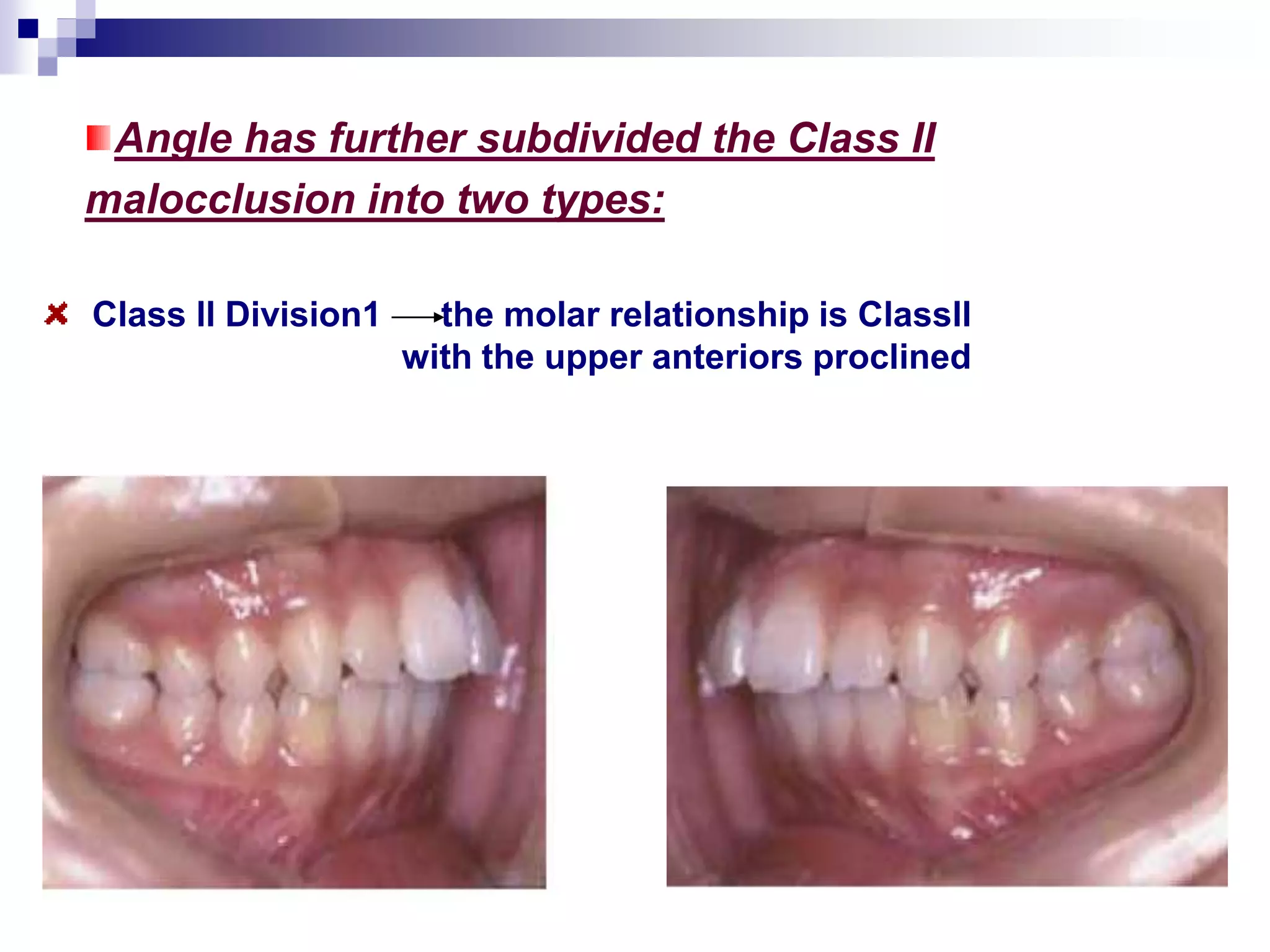 Classll etiology and management | PPT
