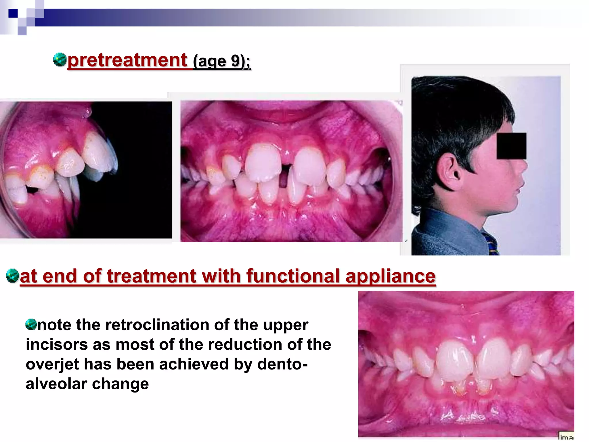 Classll etiology and management | PPT