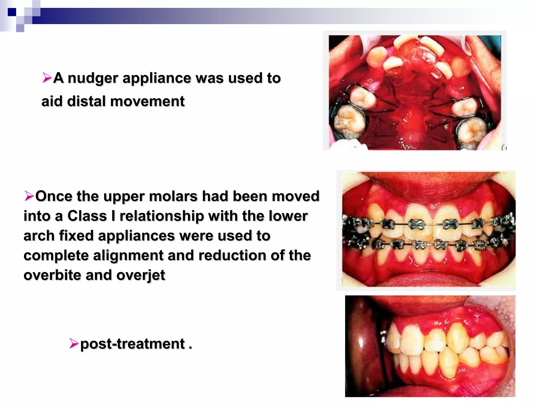 Classll etiology and management | PPT