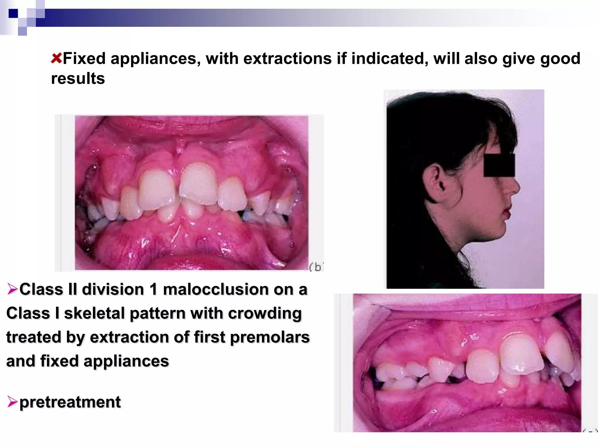 Classll etiology and management | PPT