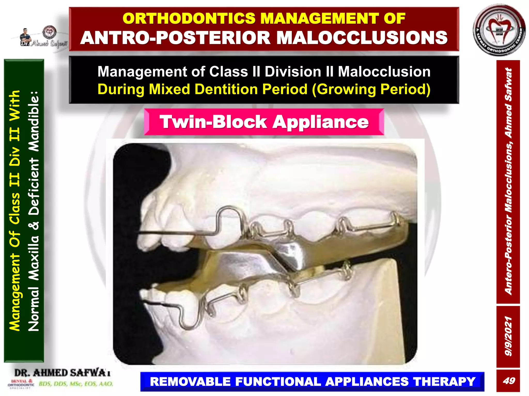 Orthodontic Management of Class ll malocclusion by Ahmed Safwat | PPTX