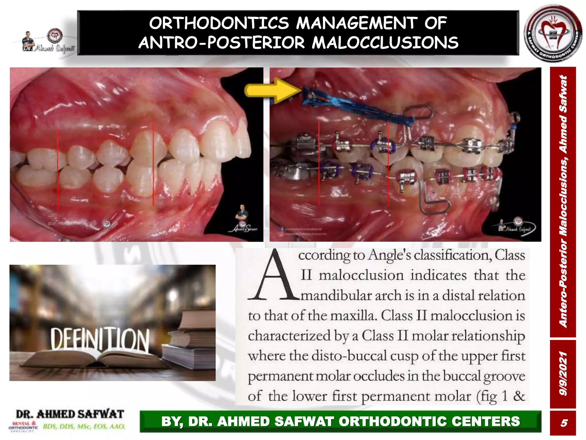 Orthodontic Management of Class ll malocclusion by Ahmed Safwat | PPTX