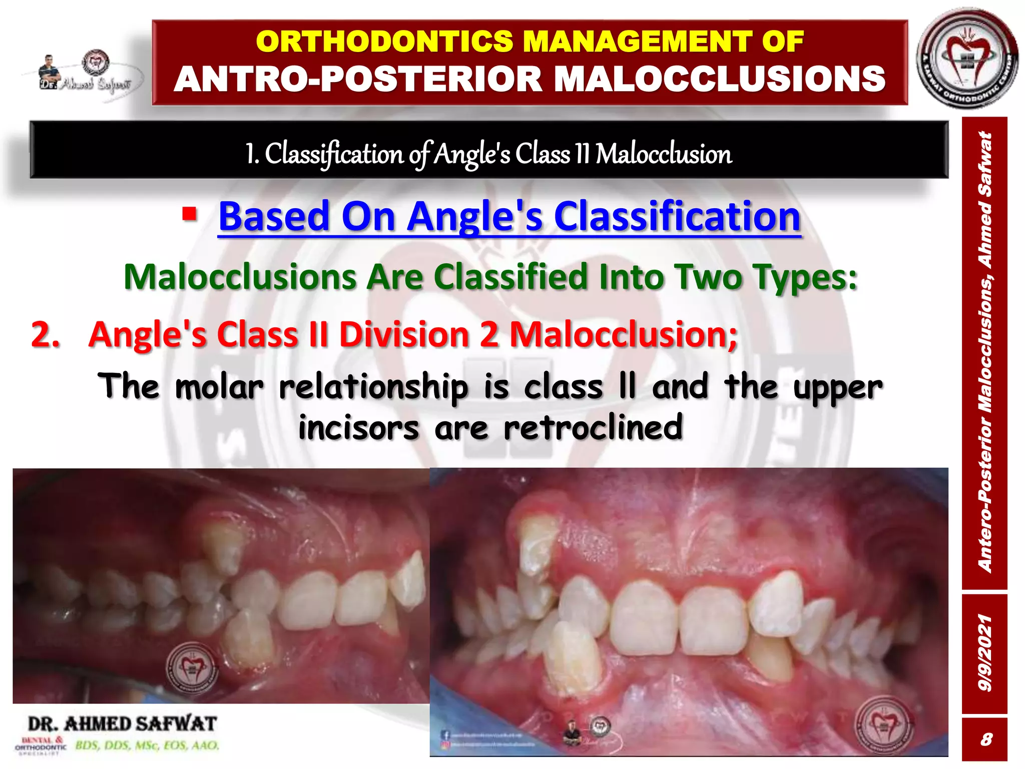 Orthodontic Management of Class ll malocclusion by Ahmed Safwat | PPTX