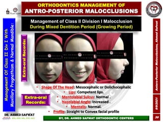 Orthodontic Management of Class ll malocclusion by Ahmed Safwat | PPTX