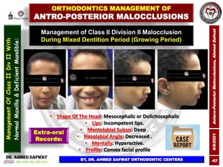 Orthodontic Management of Class ll malocclusion by Ahmed Safwat | PPTX