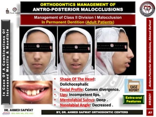 Orthodontic Management of Class ll malocclusion by Ahmed Safwat | PPTX