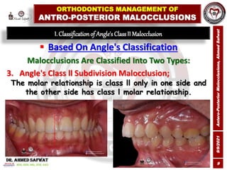 Orthodontic Management of Class ll malocclusion by Ahmed Safwat | PPTX