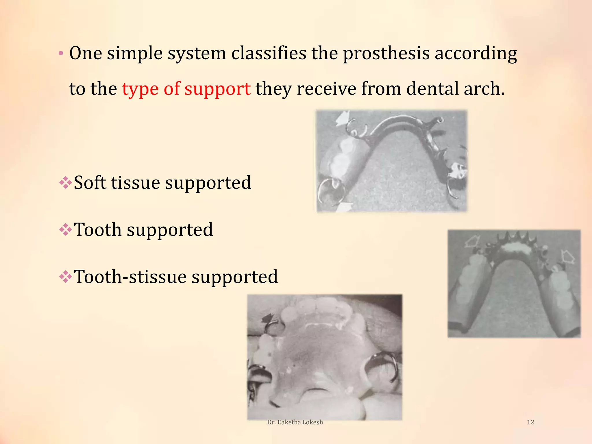 Classification systems for partially edentulous arches | PPTX